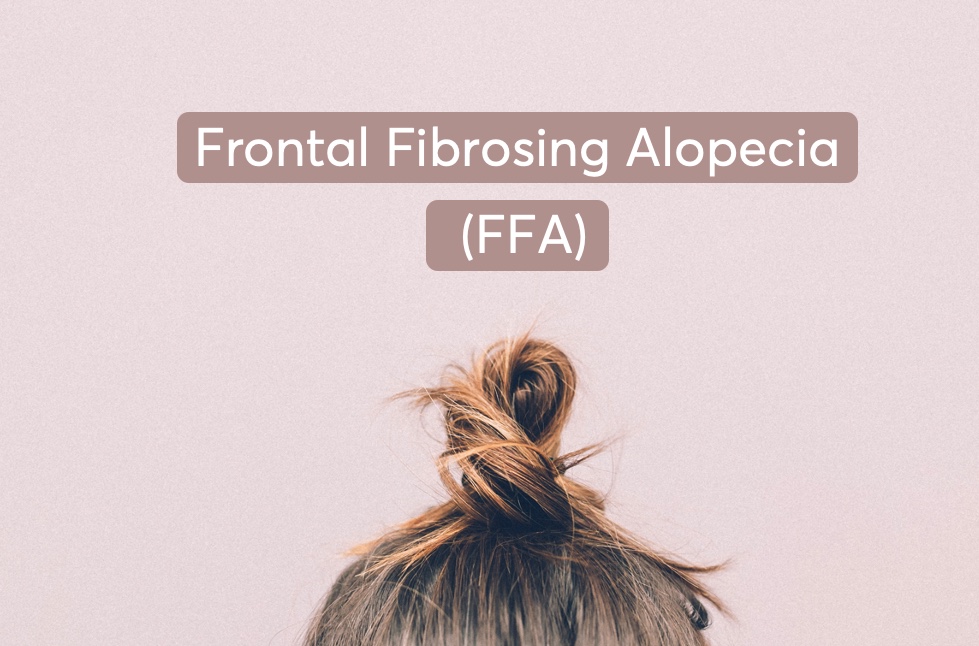 Frontal Fibrosing Alopecia (FFA) | MDhair