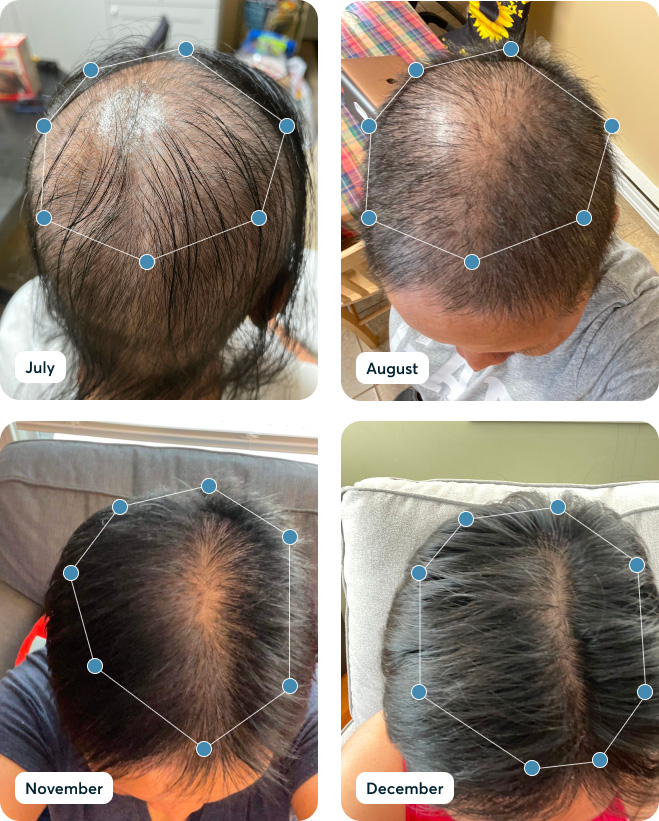 MDhair Reviews and Before and After Results
