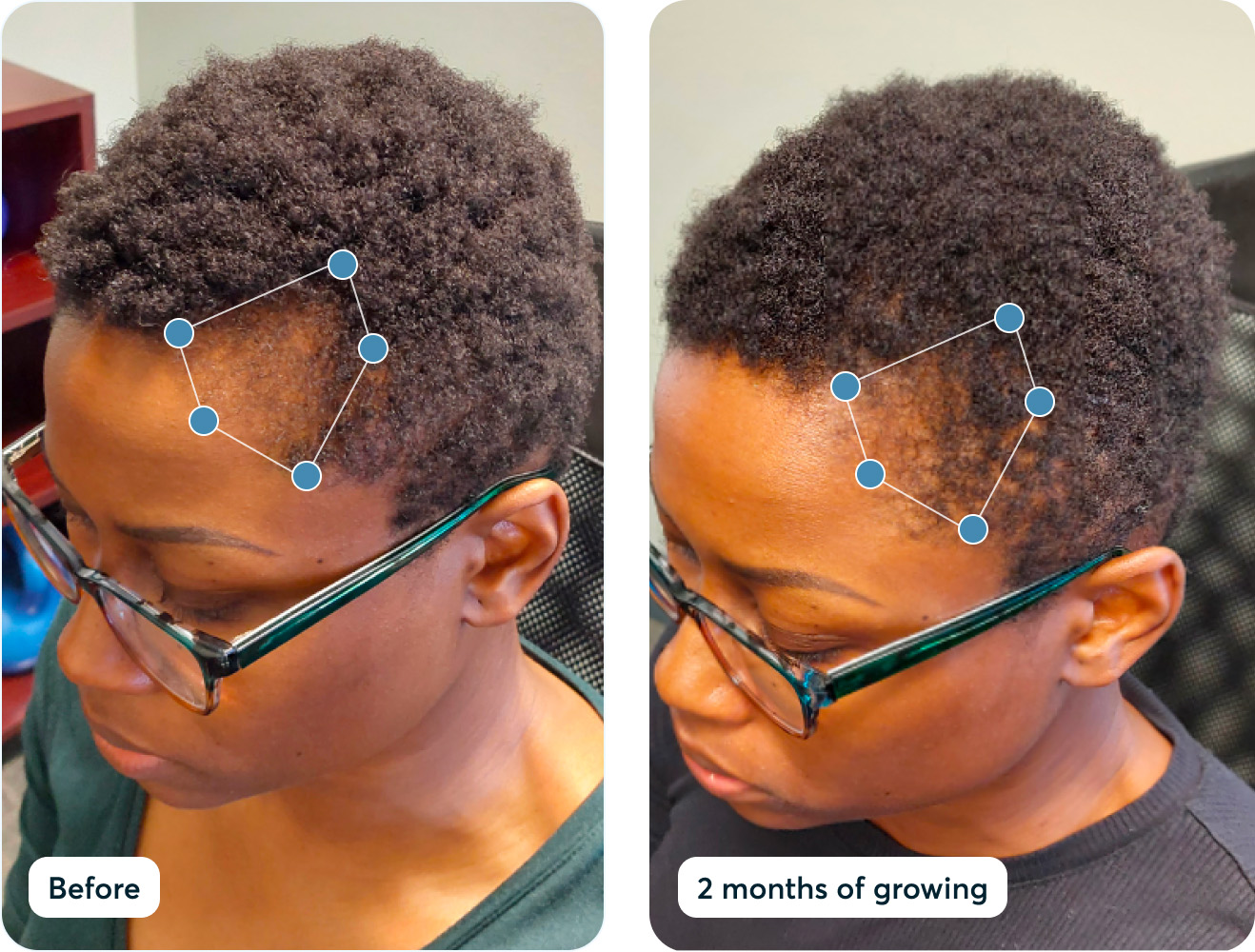 MDhair Reviews and Before and After Results