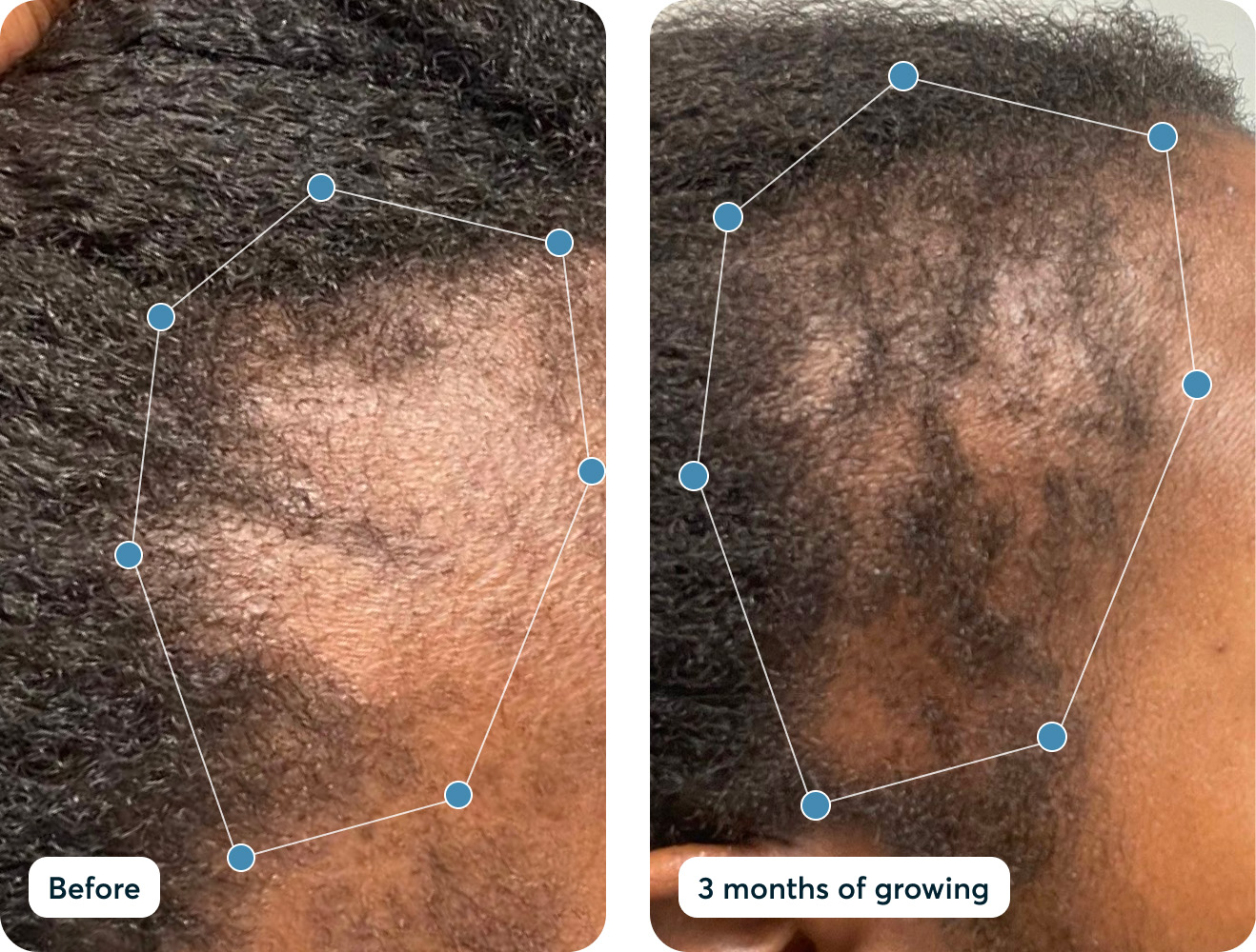 MDhair Reviews and Before and After Results