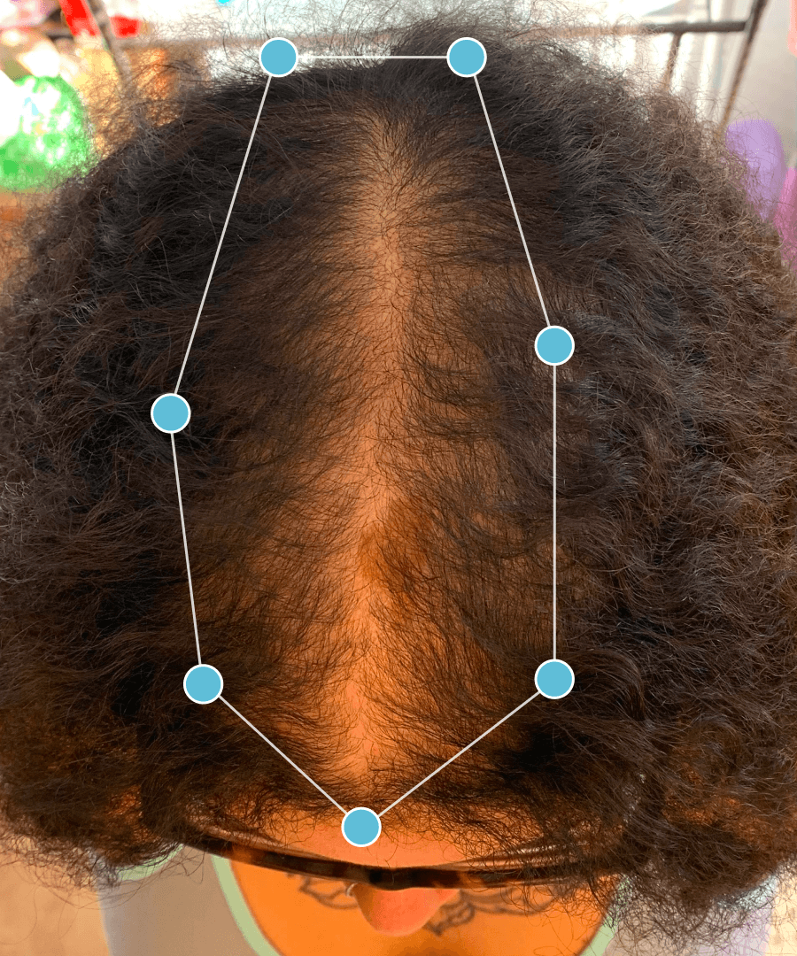 MDhair - Custom Hair Growth Treatment