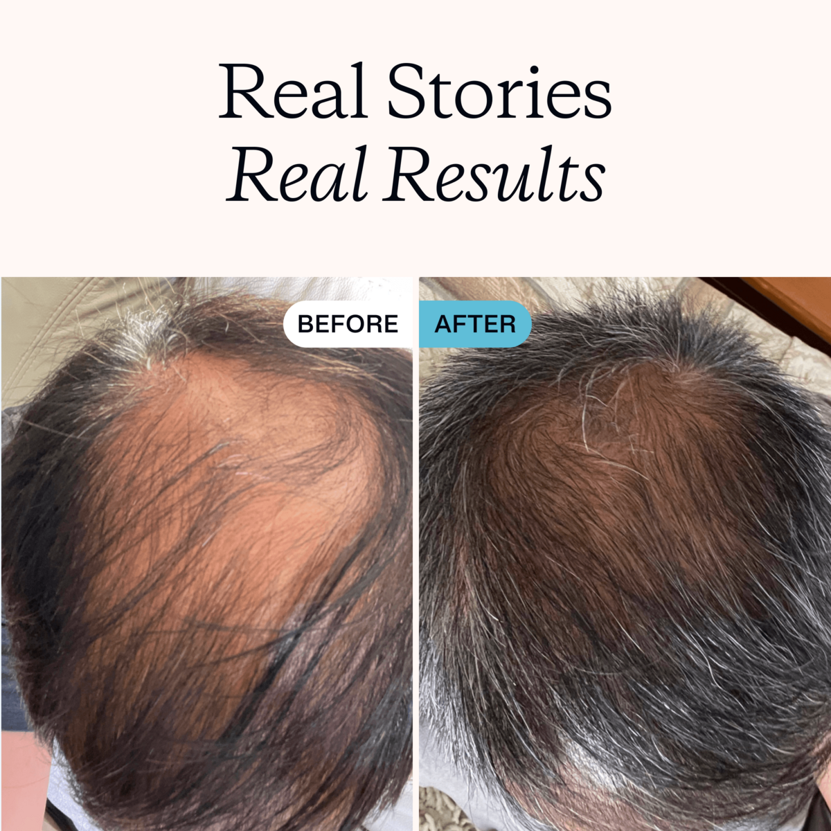 Regrowth Serum | MDhair